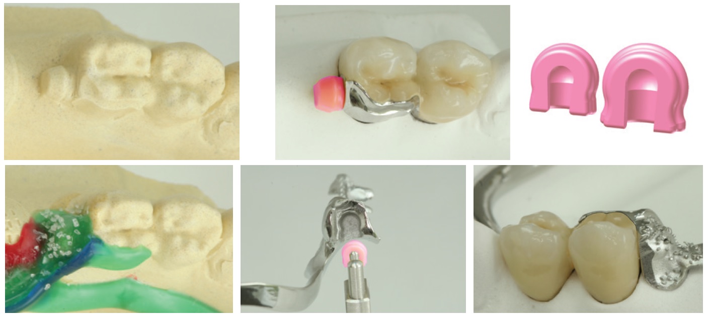 Matrice Duplicare Roz SX (Preci Sagix) Hader - DoriotDent
